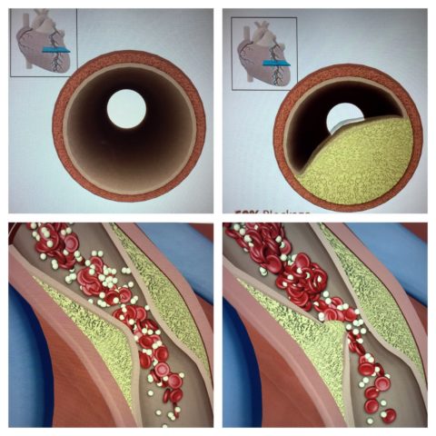 Cardiac Catheterization | Advanced Cardiovascular Clinic